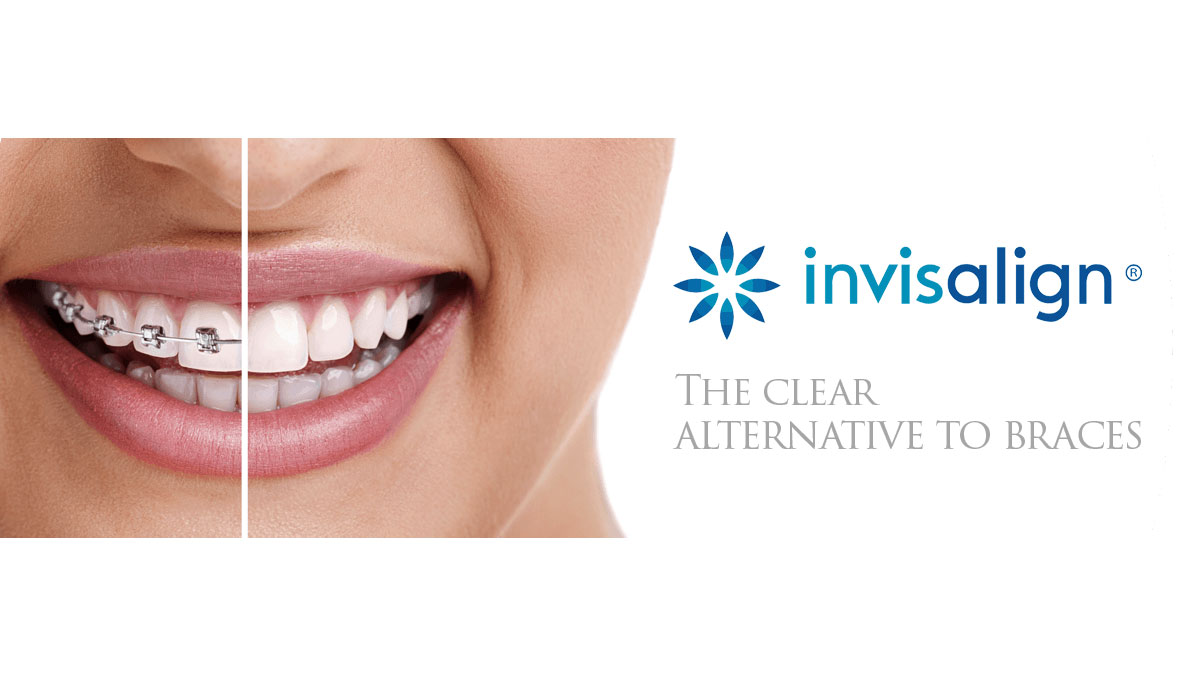 Choosing Between Traditional Metal Braces and Invisalign: A ...